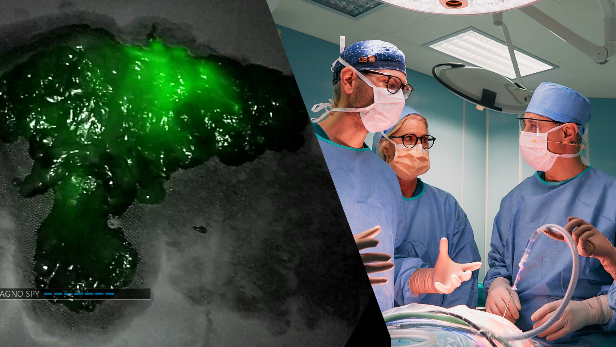 Sigmoidectomy for sigmoid cancer with left colic artery sparing - ICG ...