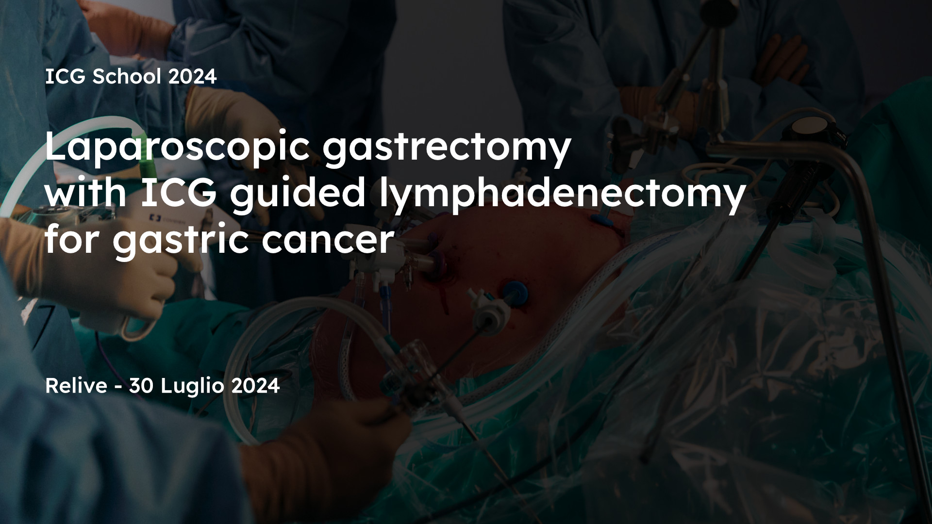 Laparoscopic gastrectomy with ICG guidedlymphadenectomy for gastric ...